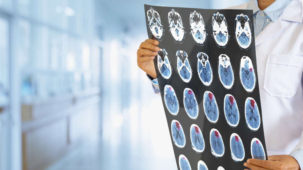 Key to post-stroke survival: data and algorithms to improve the quality ...